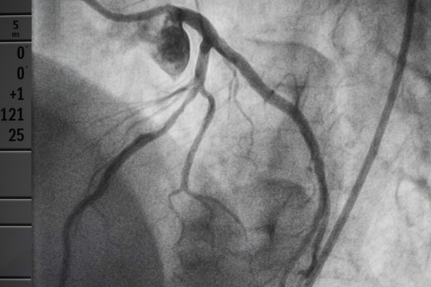 How to Use GE MACVU 360 for Early Detection of Heart Disease