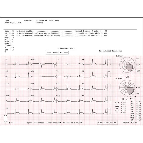 Philips TC35 Pagewriter EKG Machine | Heart Medical